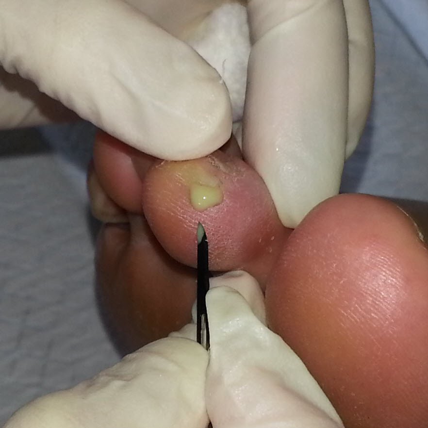 pus infection