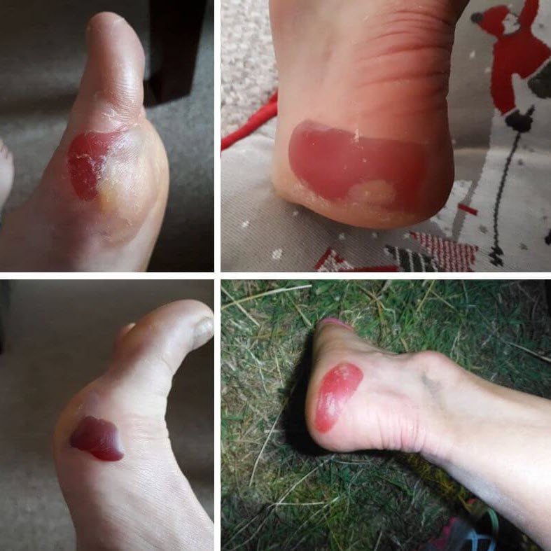 Open Blisters Running Blisters Treatment And Prevention