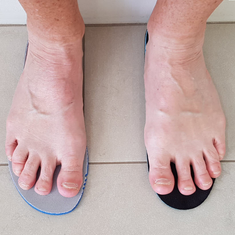 Toe Fit Check: 2 Things Your Insole Can Tell You About Shoe Fit